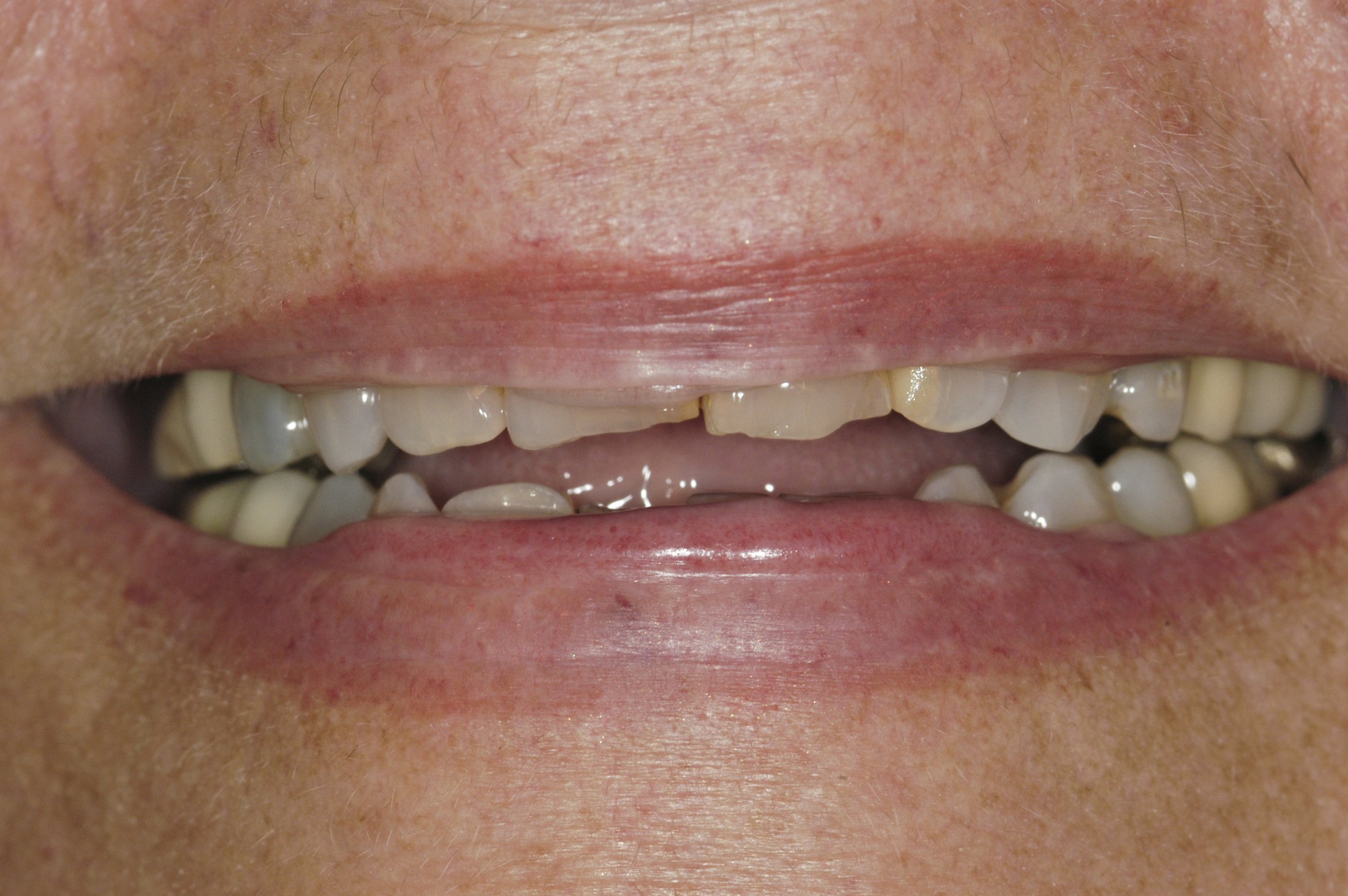Full Mouth Reconstruction Photos Duluth MN | Examples of Dental Work