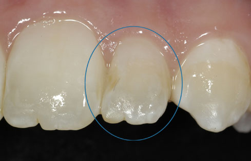 Single Implant Crown Photos Duluth MN | Dental Crown Photos