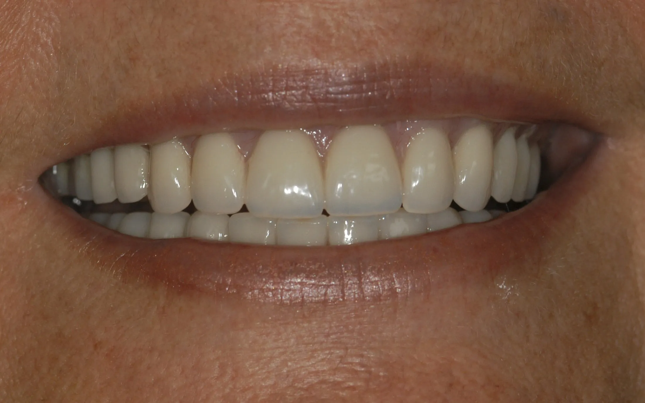 Dental Implant Photos | Smile Gallery | Dental Before & After Photos